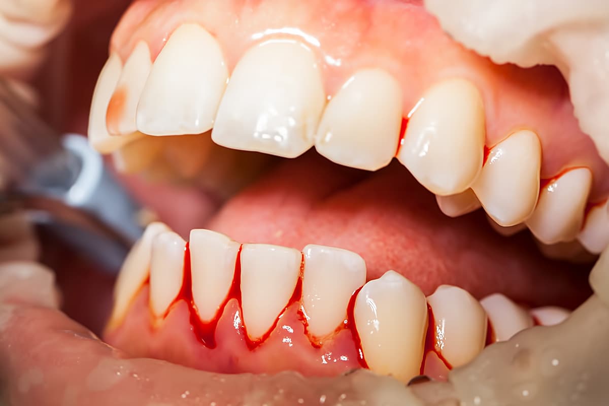 How To Prevent Bleeding Gums TX Oral Healthcare